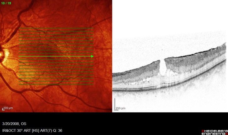 ERM - The Retina Centers of Washington