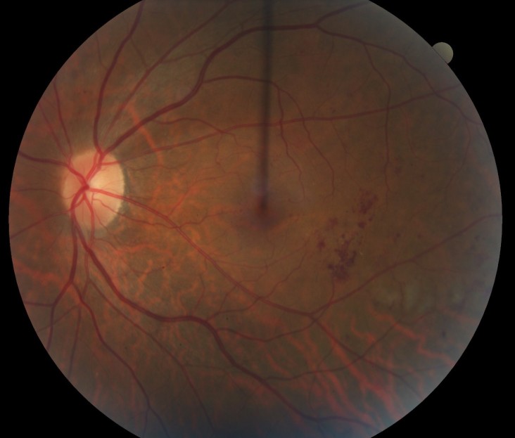 Diabetic Retinopathy – The Retina Centers of Washington