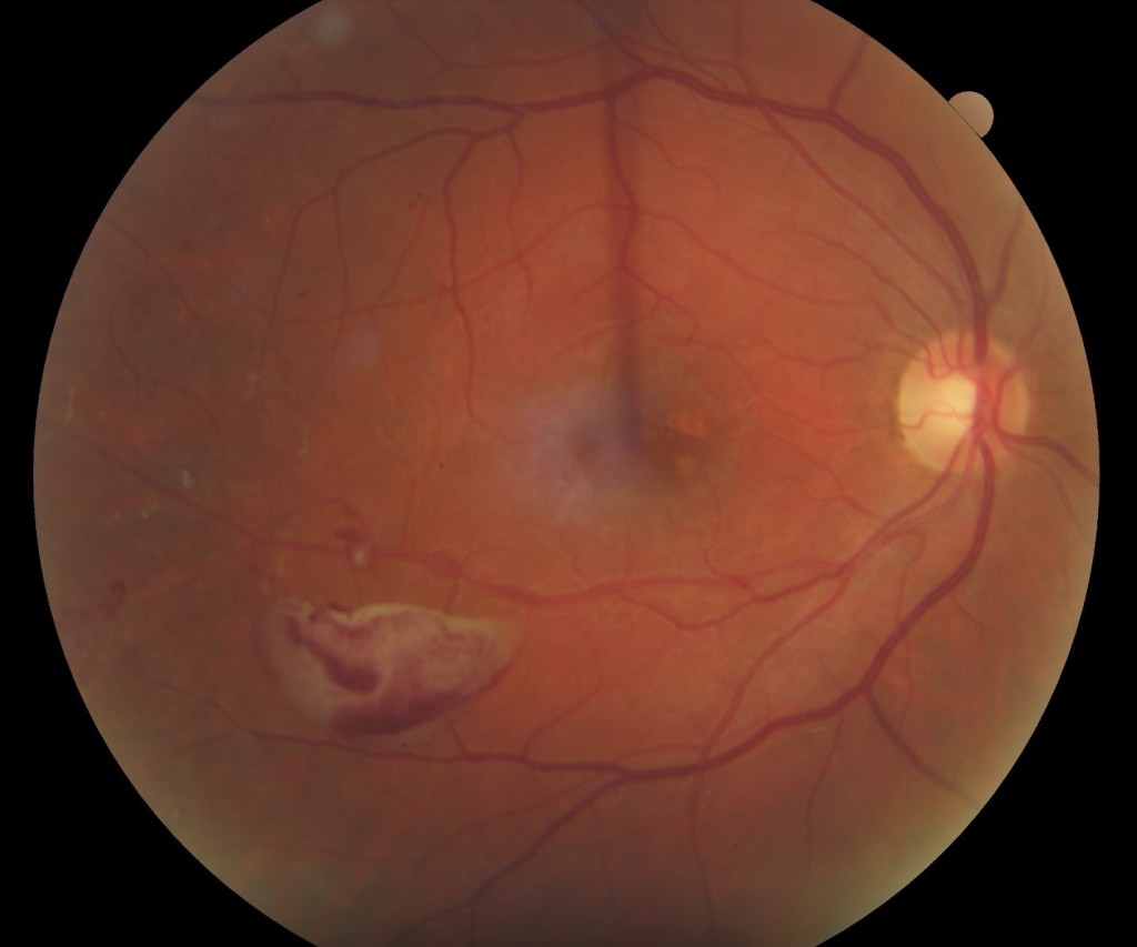 Diabetic Retinopathy – The Retina Centers of Washington