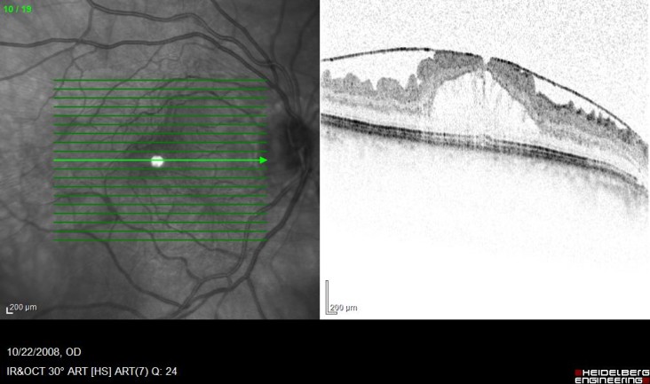 EPIRETINAL MEMBRANE - The Retina Centers of Washington
