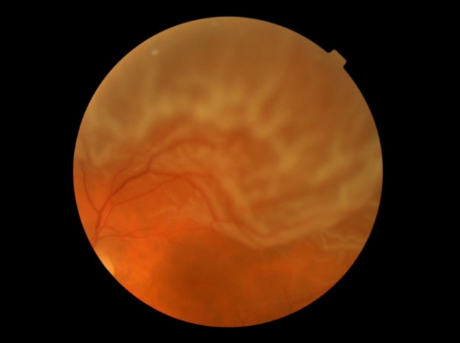 Retinal tear and detachment – The Retina Centers of Washington