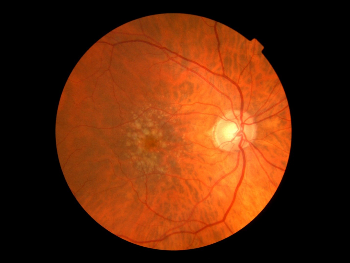 Macular Degeneration The Retina Centers Of Washington