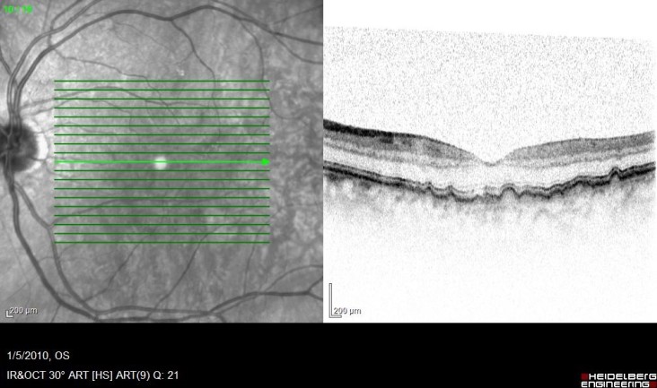 Macular Degeneration – The Retina Centers of Washington