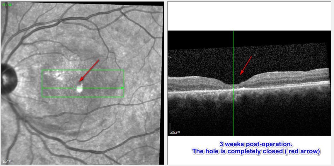Macular post-op - The Retina Centers of Washington
